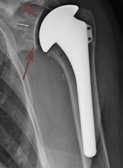 Shoulder Arthritis / Joint Replacement : Total shoulder - failure at 10 ...