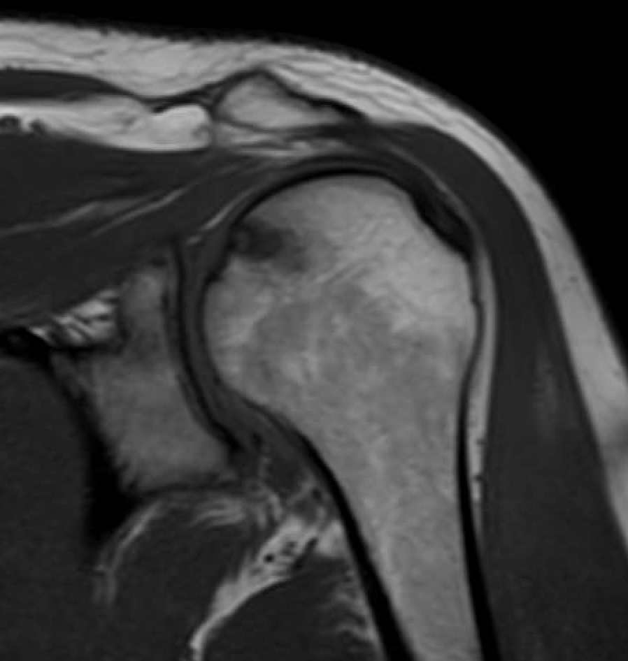 UW Shoulder and Elbow Academy: Avascular necrosis in a patient under 40 ...