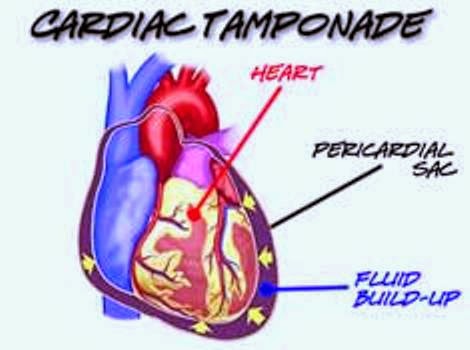 Cardiac Tamponade ~ THE NURSING CORNER