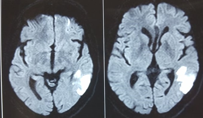 Wernicke's Aphasia : MRI - Sumer's Radiology Blog