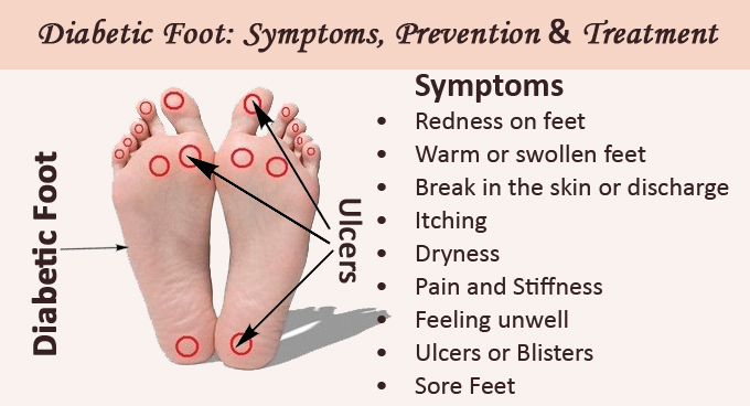 Signs & Complications of Diabetes Foot Problems for Diabetic Patients ...