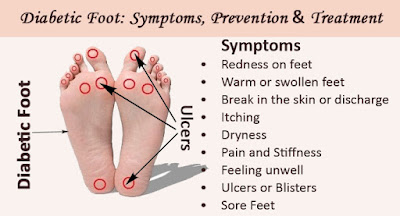 Signs & Complications of Diabetes Foot Problems for Diabetic Patients ...