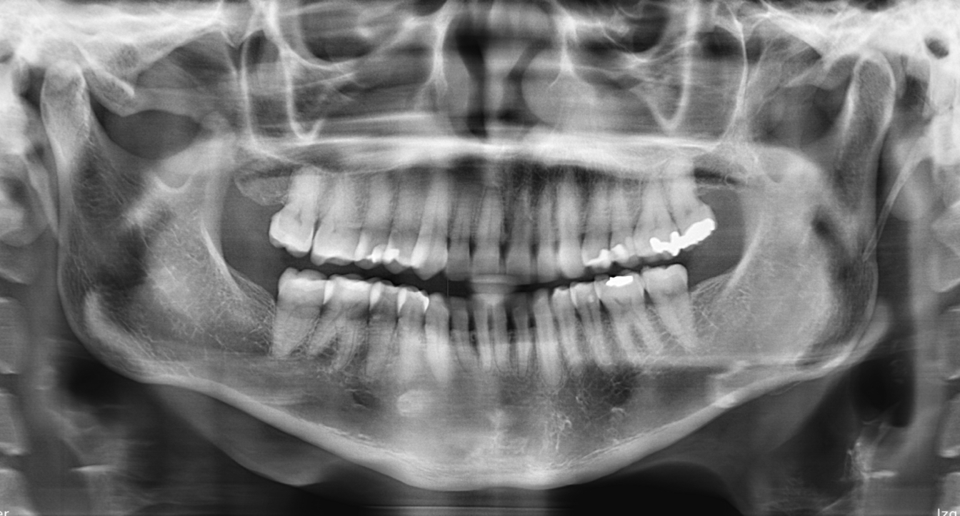 CIDEM: APÓFISIS ESTILOIDES ELONGADA