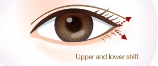 BK Plastic Surgery: [BK Plastic Surgery] Eye Surgery: Outer Corner ...