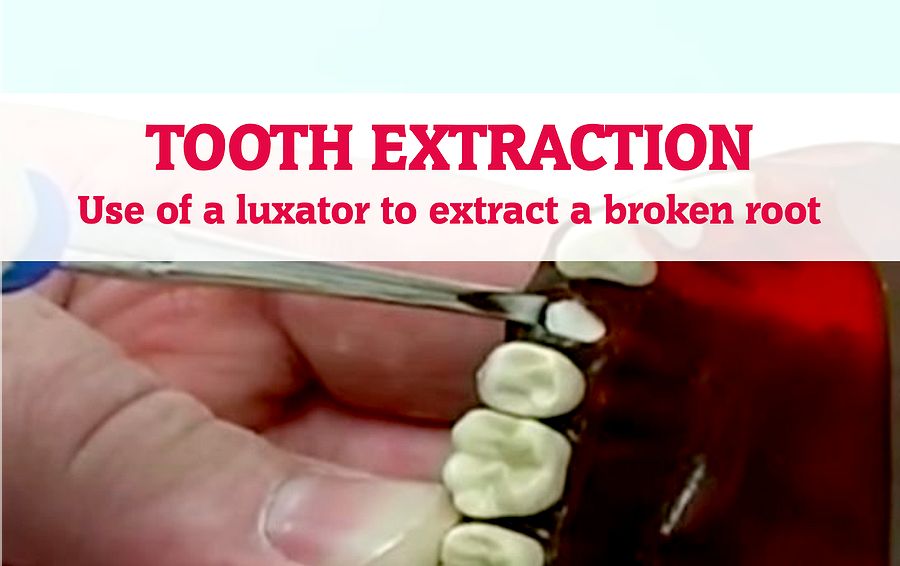 TOOTH EXTRACTION: Use of a luxator to extract a broken root - Professor ...
