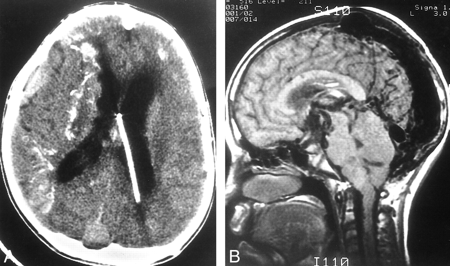 Neurology & Psychology: The importance of early diagnosis of subdural ...