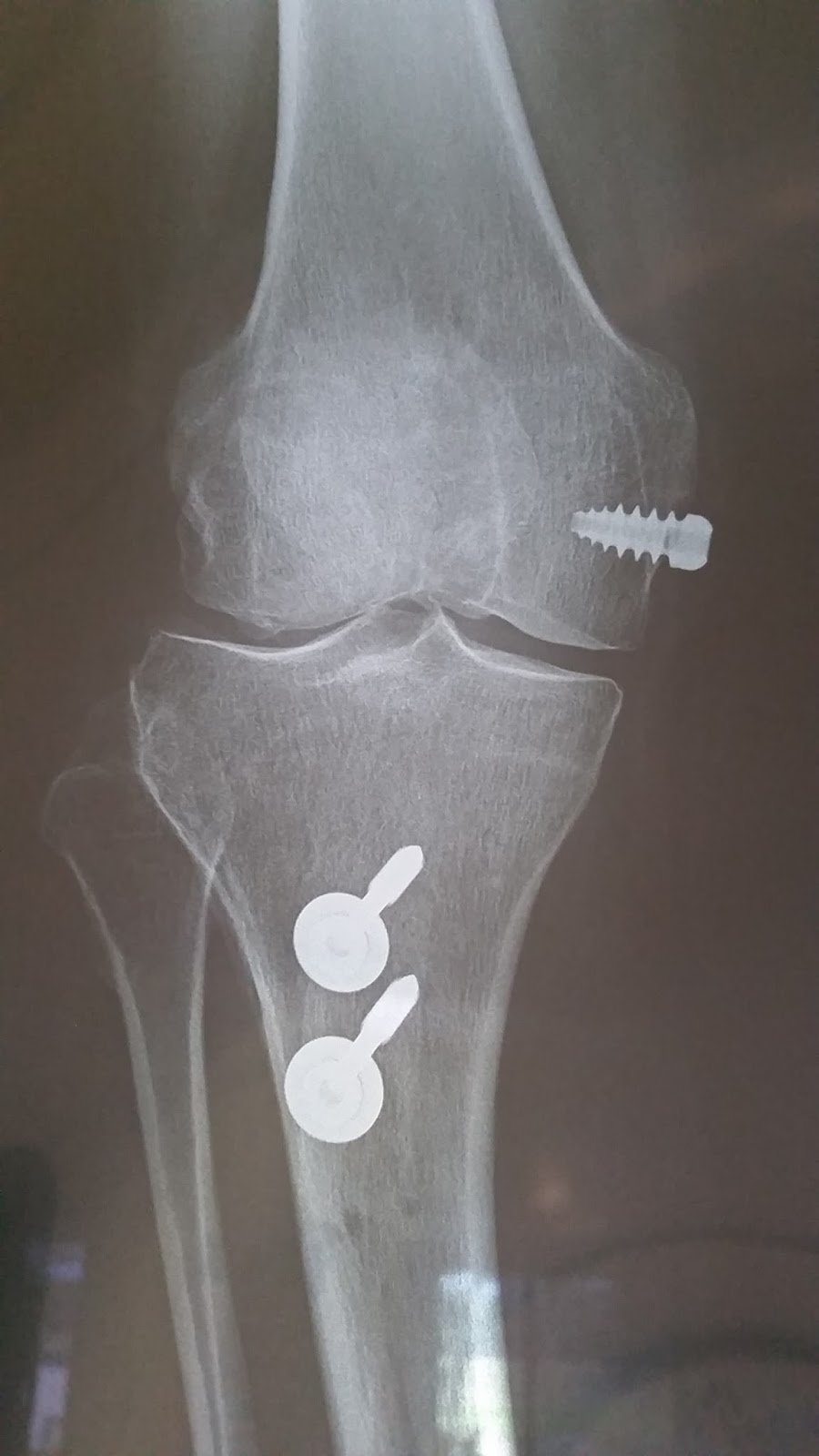 Journey of a Medial Patello-Femoral Ligament repair and Tibial Tubercle ...