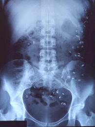 Radiologia para Técnicos: TEMPO DE TRÂNSITO COLÔNICO: