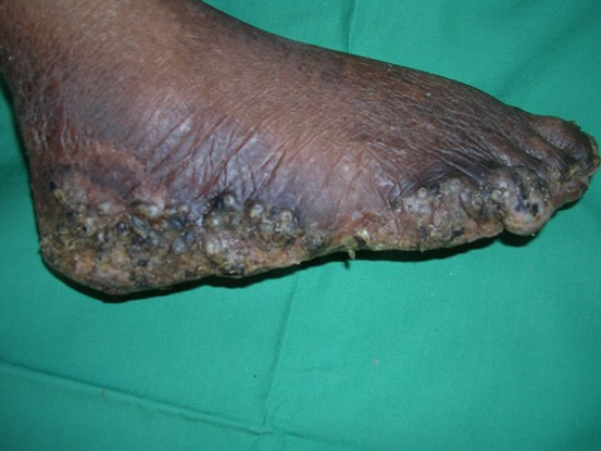 Chaaria Mission Hospital - Kenya: Tungiasis