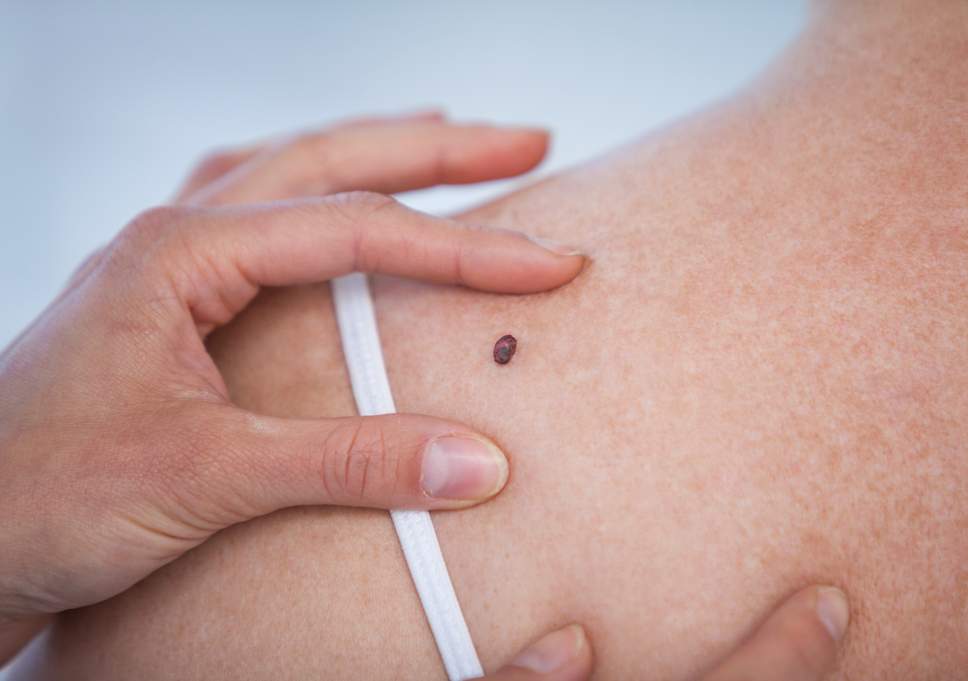 ΚΑΡΚΙΝΟΣ ΤΟΥ ΔΕΡΜΑΤΟΣ | MEDLABNEWS.GR / IATRIKA NEA