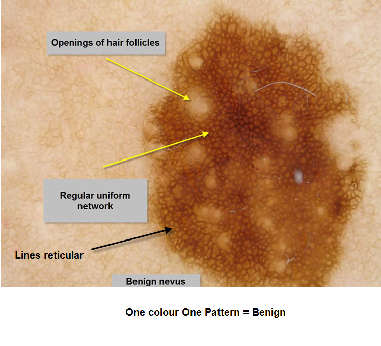 Dermoscopy Features as Clues: Lines Reticular