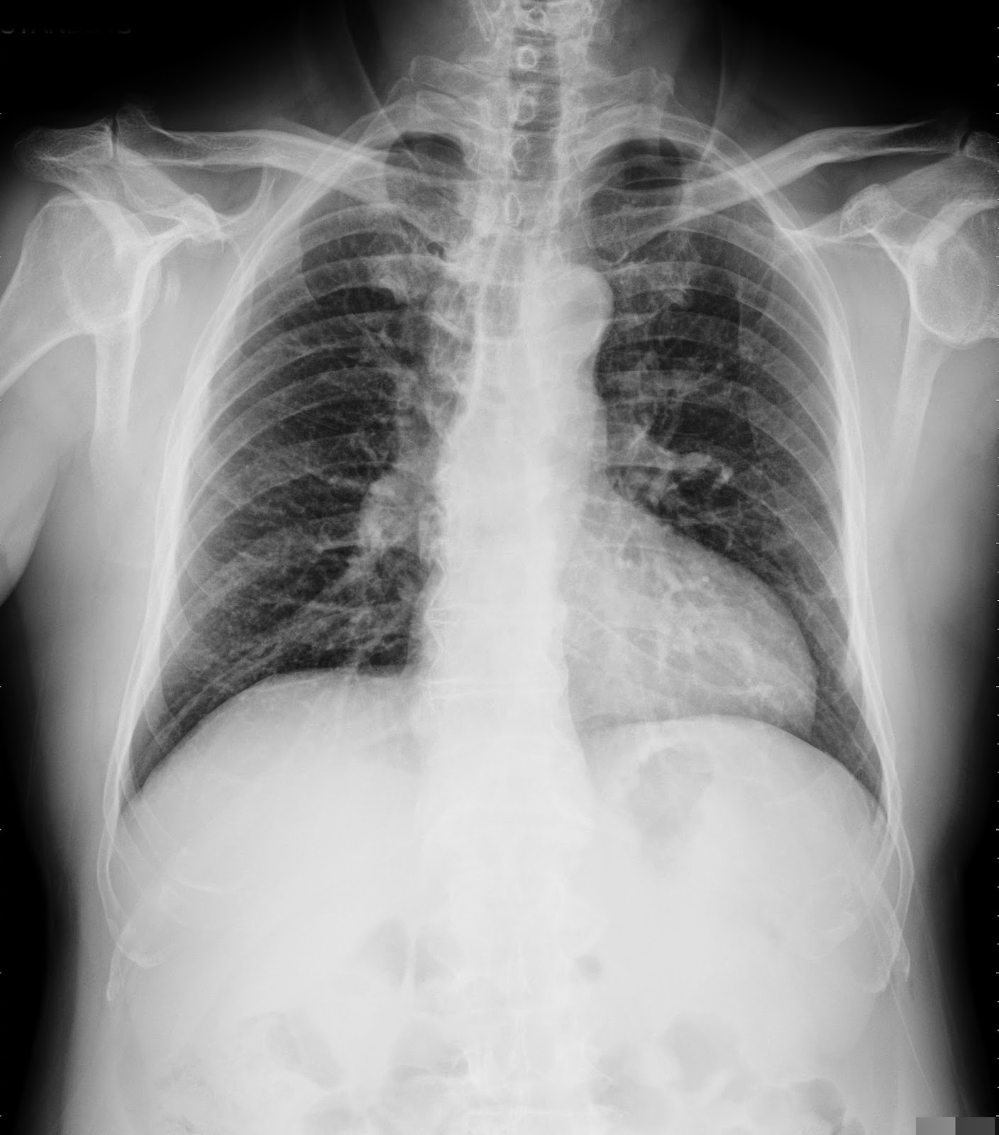 CXR 胸部x光判讀 pulmonary cryptococcus