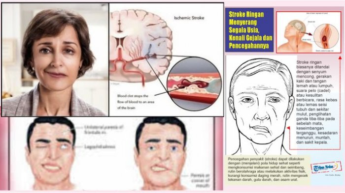 Sembuhkan Stroke Tanpa Operasi