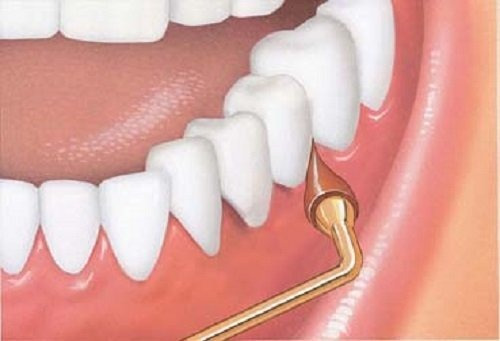 Medidas preventivas en odontología