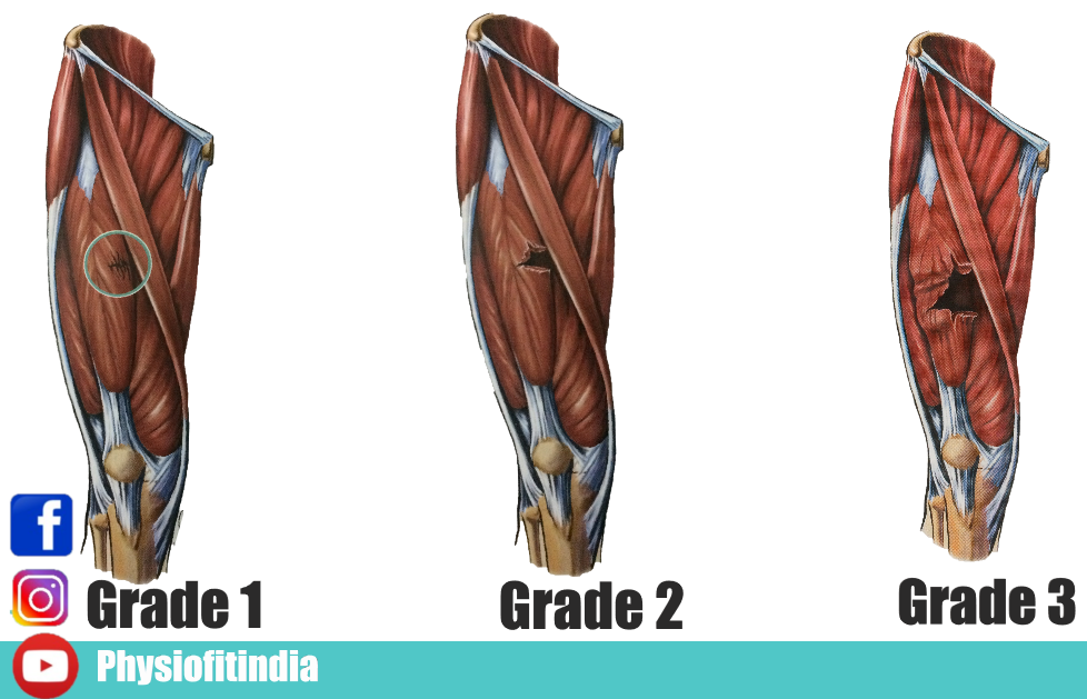 Muscle Strain/tear Type of grade and management