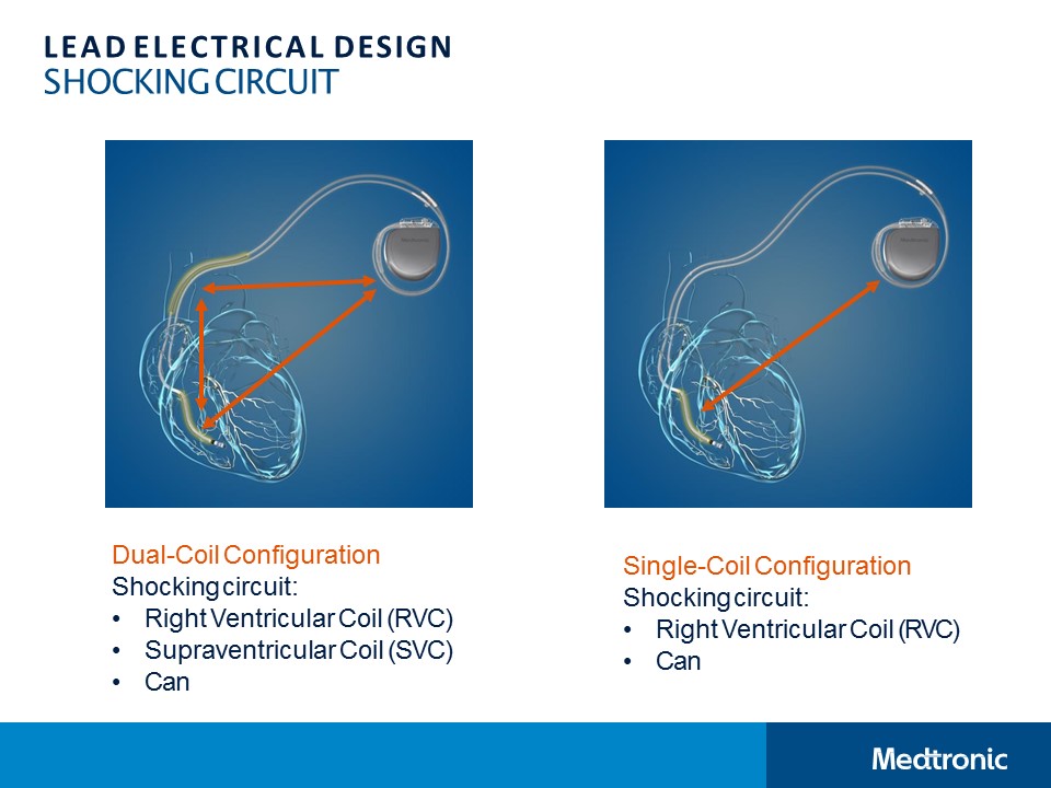 CVT Mohd Farid: Concept Of ICD Technology-Sensing & Detection-Medtronic ...