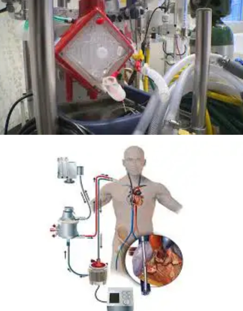 ECMO ( Extra Corporeal Membrane Oxygenation) treatment - an ...