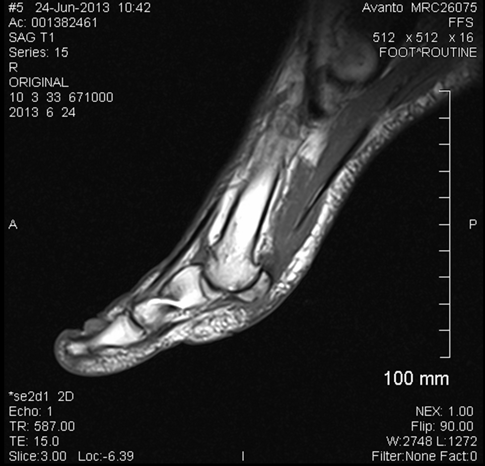 wtf is wrong with my toe???: Toe MRI