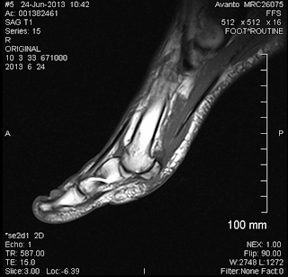 wtf is wrong with my toe???: Toe MRI