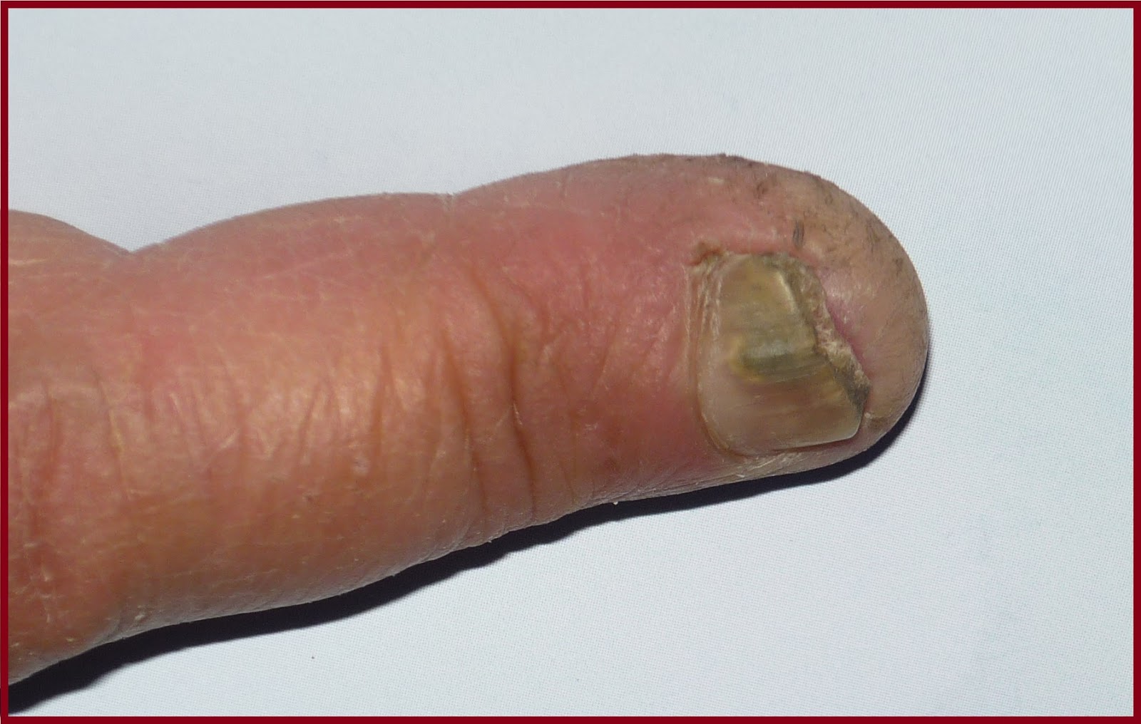 Fungal Infections: Causes, Types, Symptoms of Ringworm (Tinea) and its ...