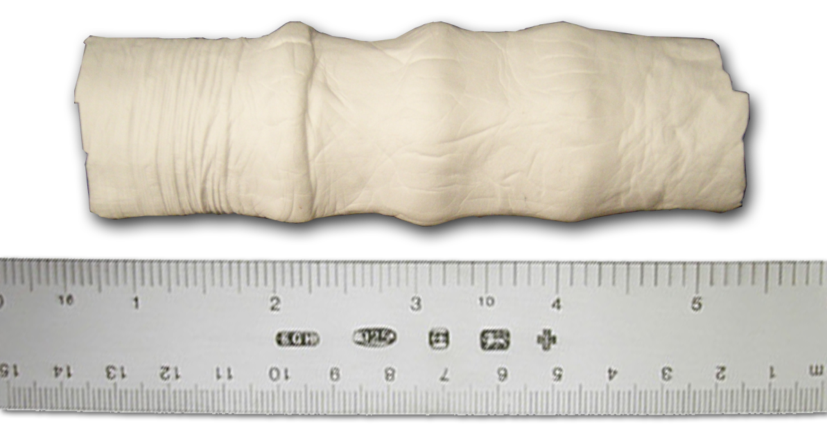 Neuromics: Laryngotracheal Transplantations Using Nanofiber Solutions ...