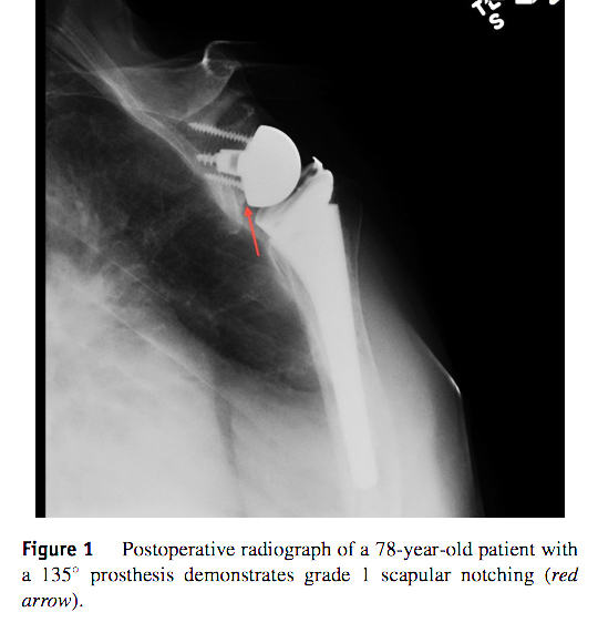 UW Shoulder and Elbow Academy: Reverse total shoulder - scapular ...