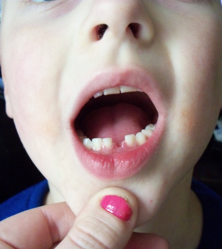 Hendrixville: Lost tooth