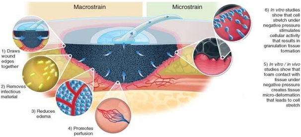 INTRODUCTION TO NPWT