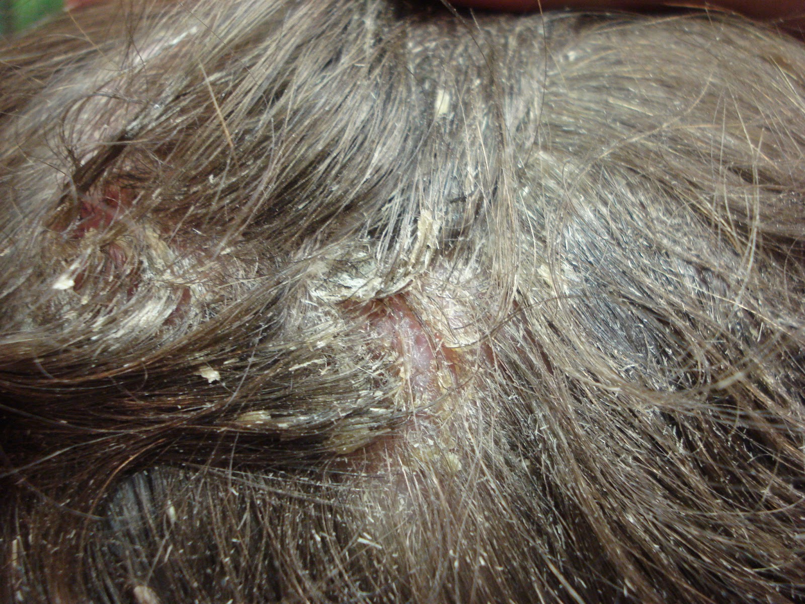 VIRTUAL GRAND ROUNDS IN DERMATOLOGY 2.0: Tinea amiantacea