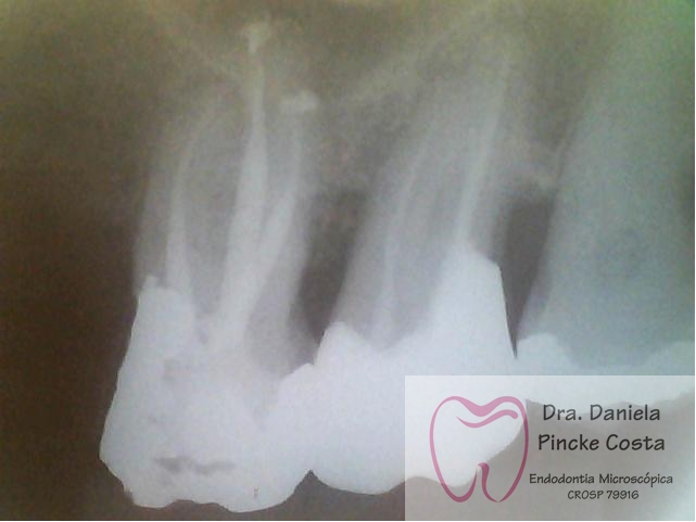 Dra. Daniela Pincke Costa: Endodontia dente 26
