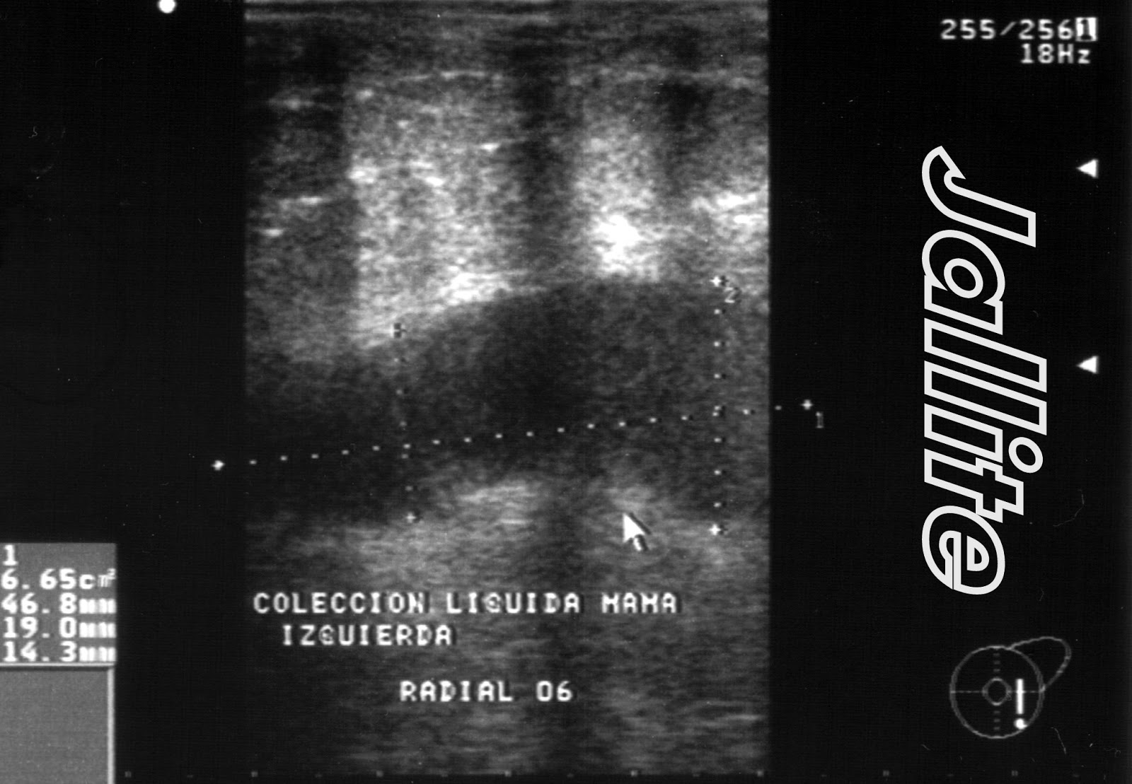 Absceso Mamario en paciente con Implantes