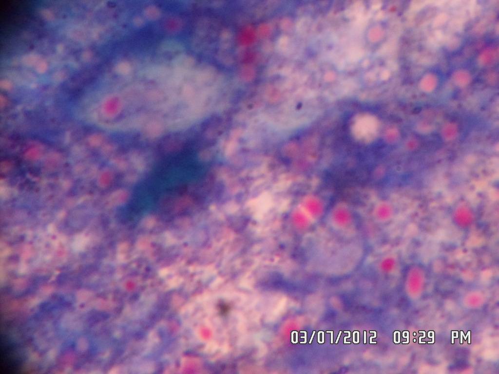 Phimaimedicine: 1,882 Cryptosporidium parvum (suspected) - diarrhea in ...