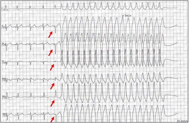 Wct Heart Rhythm
