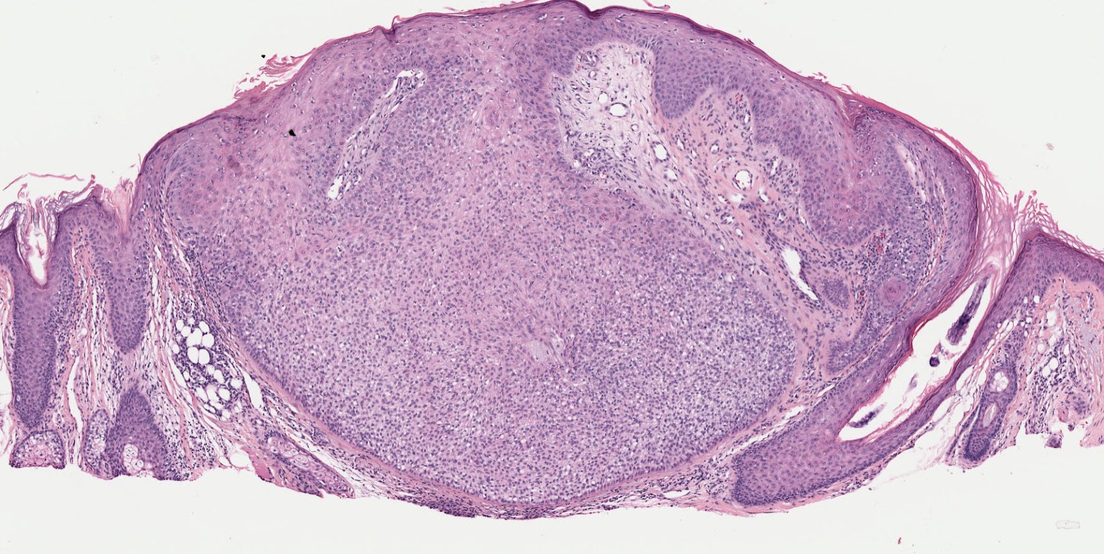 Differential Diagnosis in Dermatopathology: Follicular pathology