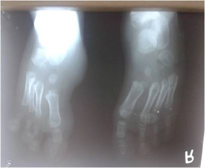 FIBULAR HEMIMELIA - Sumer's Radiology Blog