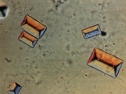 urine analysis Part 2: D.D. & urine sediments ~ Urology Notes 2012