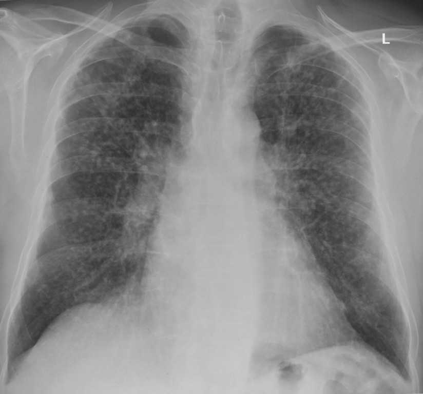 LES PNEUMOCONIOSES - COURS: Medecine du Travail | Blog Du Chalet ...