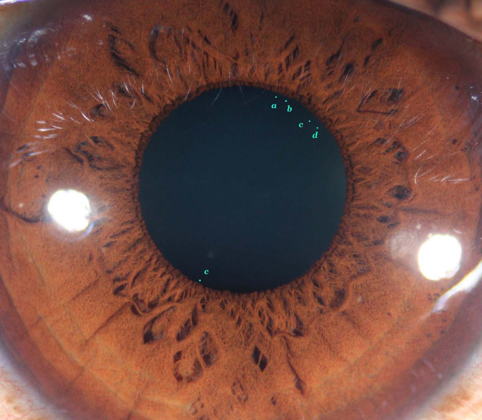 Modern & Multidimensional Iridology: Misshapen Collarette - Rx - (emran ...