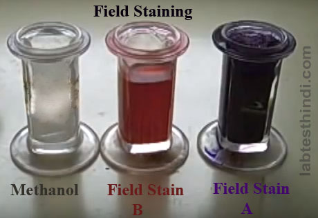 Blood Smear Slide Staining कैसे करते हैं - Field Stain ~ Lab Test Hindi