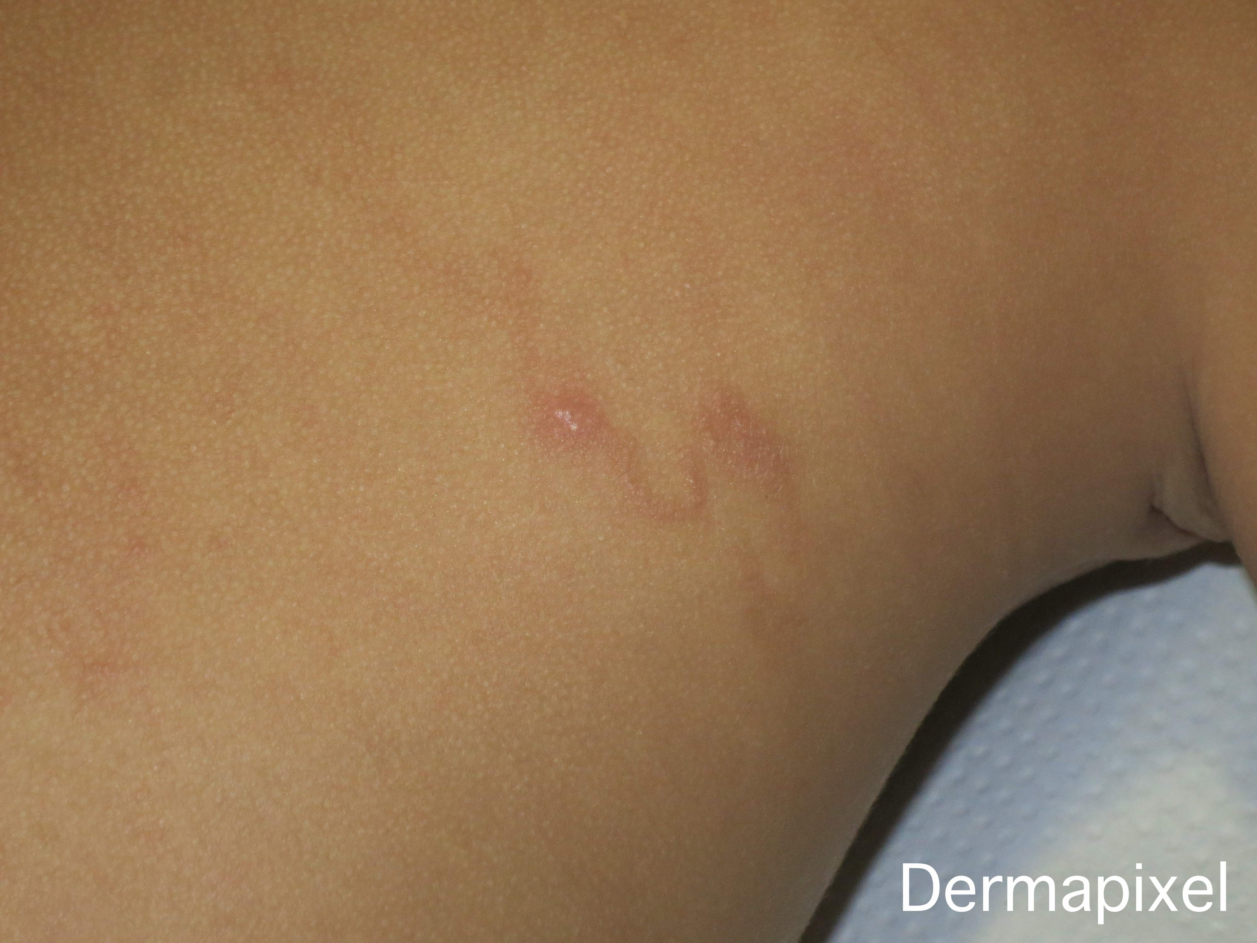 Dermapixel: Linfangitis Aguda: Cuando Las Bacterias Se Van, 46% OFF