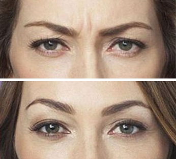 Aesthetics by Silvie: Wrinkles