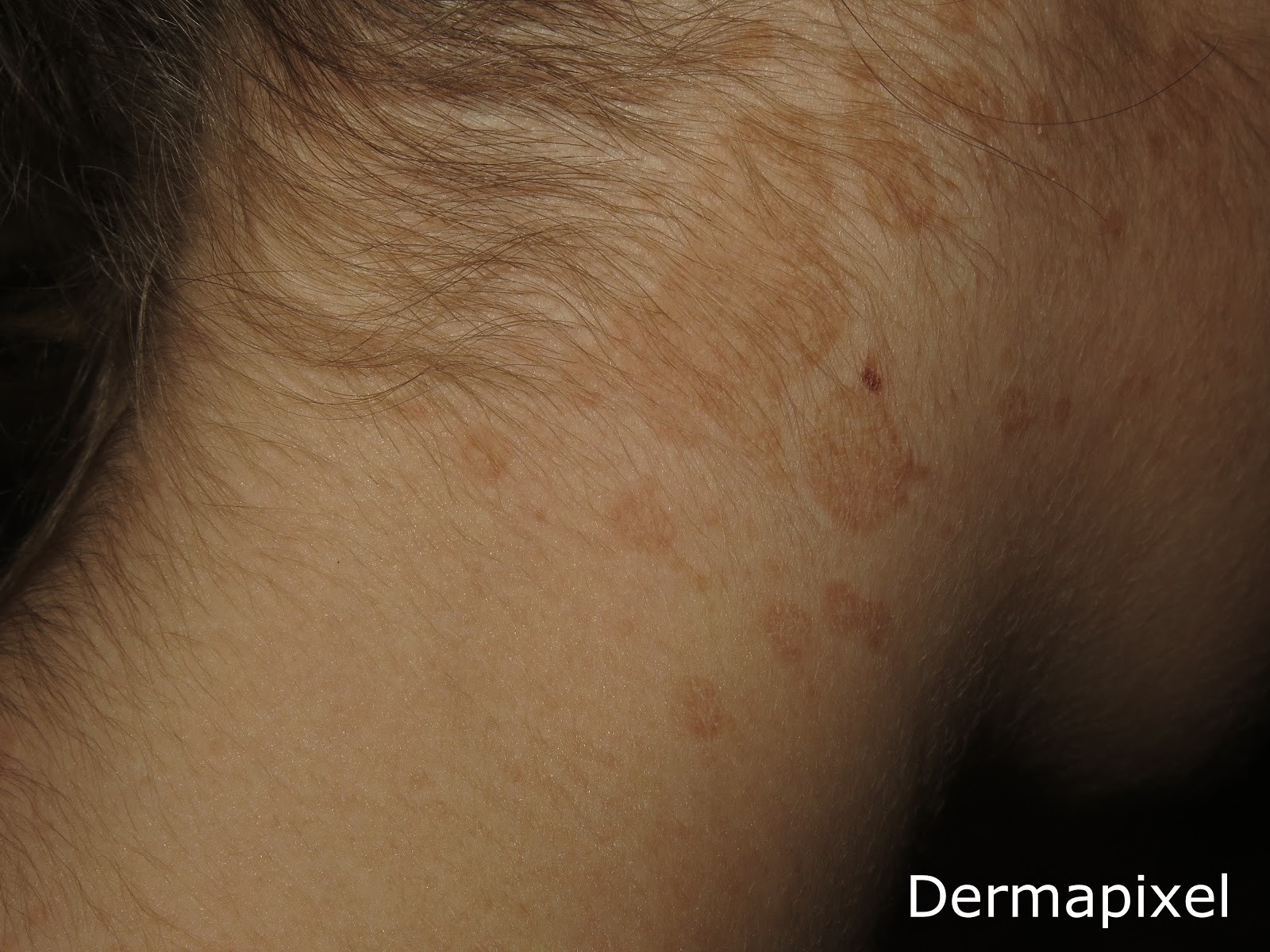 Dermapixel: Manchas que no pican