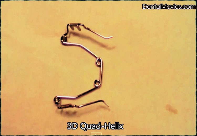 ORTHODONTICS: Insertion of the Wilson 3D Quad-Helix Appliance