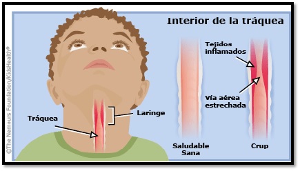¿ Qué es la laringitis o falso-croup?