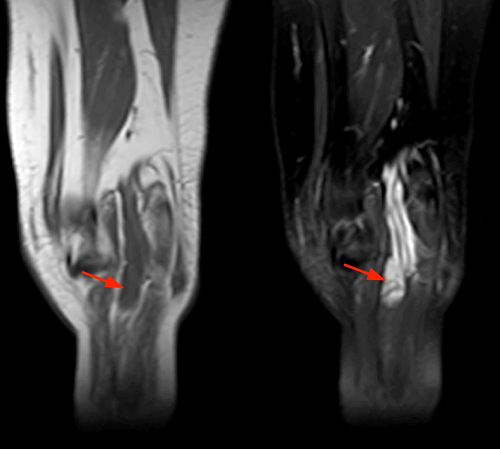 MRI Musculo-Skeletal Section: Traumatic neuroma.