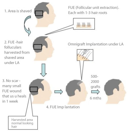 Hair Transplant cost, Doctors , Clinics, FUE hair transplant , Bio-FUe ...