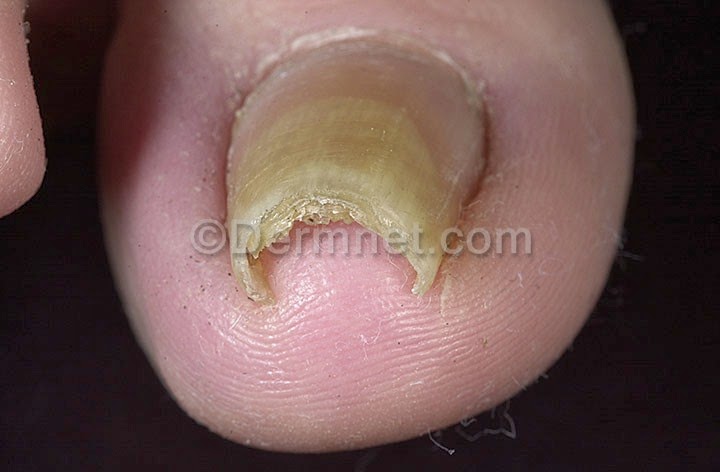 Totul despre manichiura: Pincer Nails - unghiile curbate