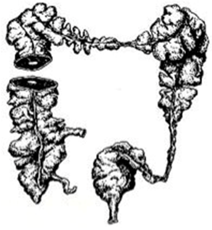 Health And Wellbeing: Healthy Colon Vs Unhealthy Colon