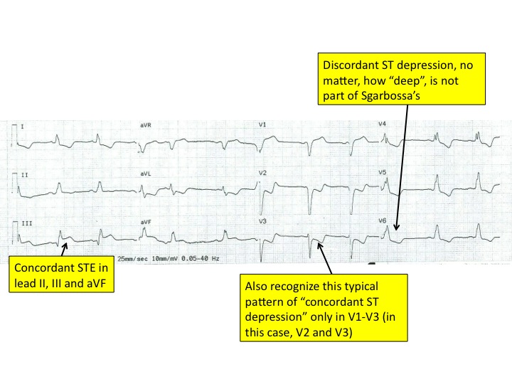 Emergency Medicine Blog: Advanced ECG by Amal Mattu in Singapore