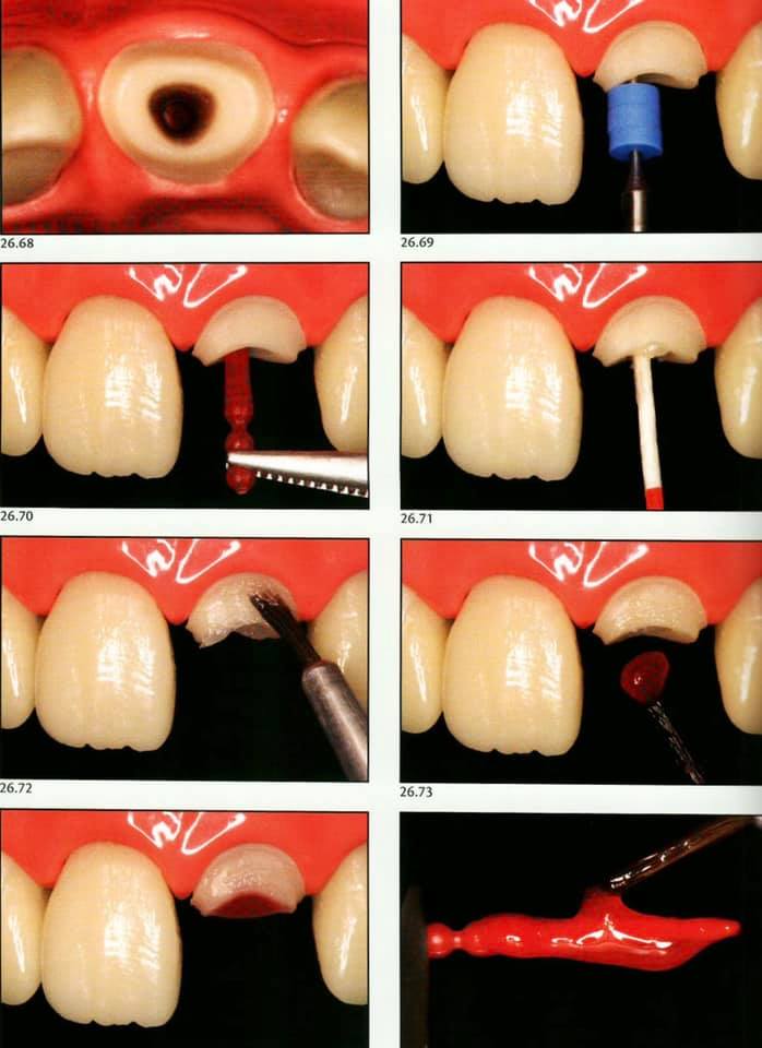 Cast metal posts | Dental Esthetics